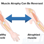 How to Fight Muscle Atrophy After Injury: A Personal Trainer’s Guide ...