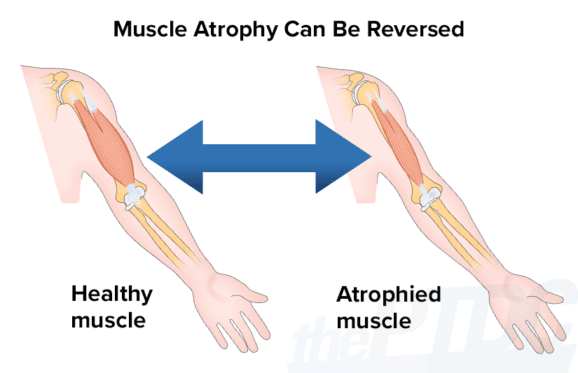 How to Fight Muscle Atrophy After Injury: A Personal Trainer’s Guide