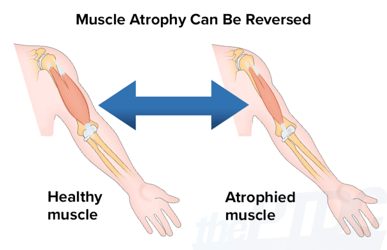 How to Fight Muscle Atrophy After Injury: A Personal Trainer’s Guide